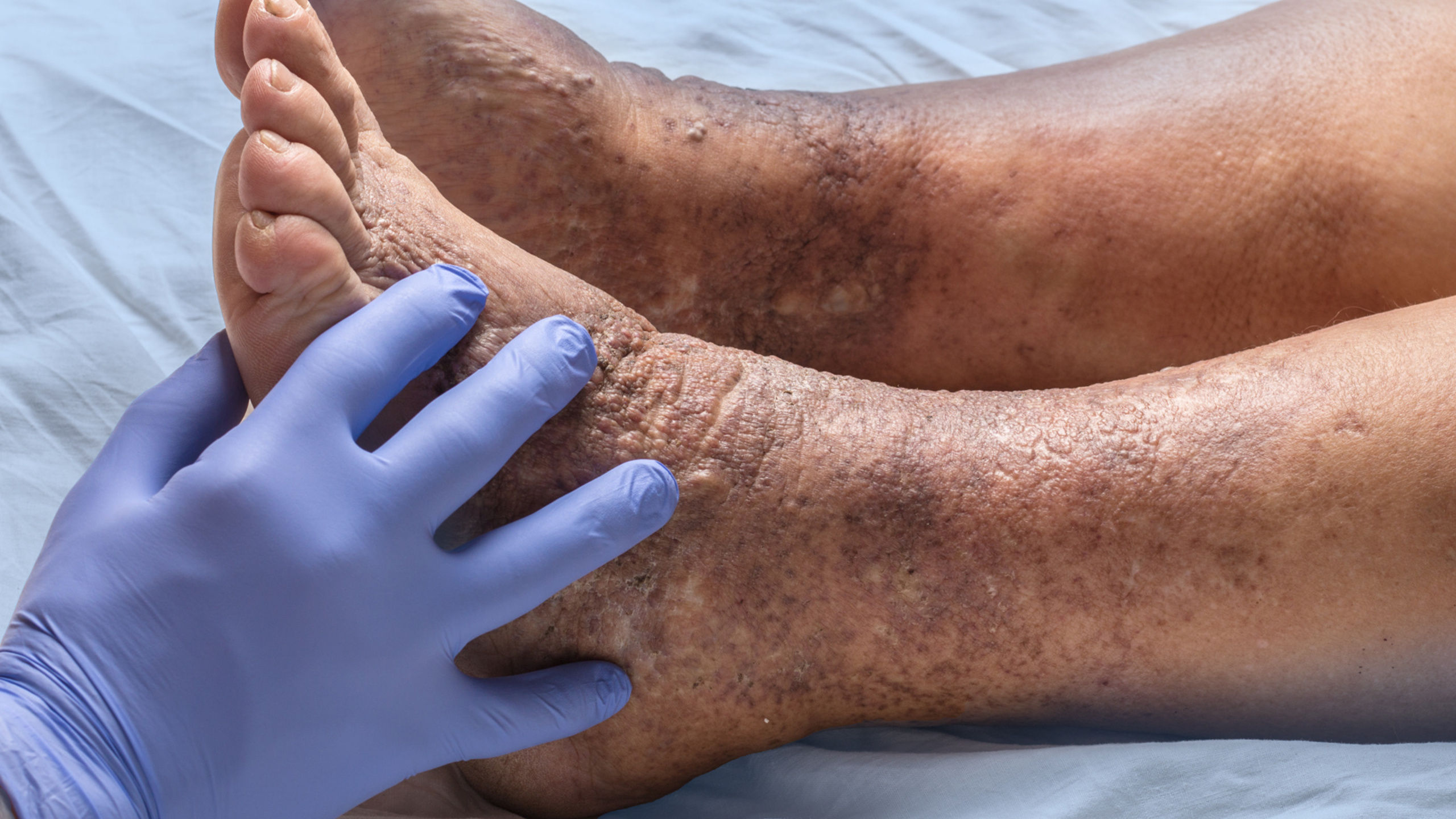 Durchblutungsstörungen der Beine - Beschreibung, Behandlung